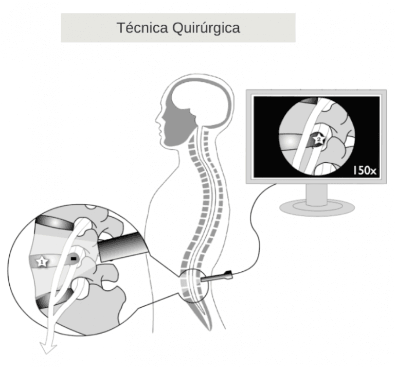 Indicaciones y contraindicaciones para la discectomía video endoscópica ...